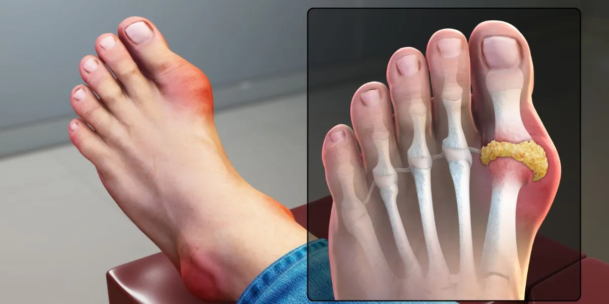 Uric Acid Gout Vs Arthritis: Key Differences In Pain And Symptoms ...