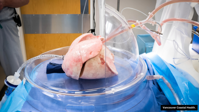 Life-Saving Lung Transplants could be a game changer with "Lungs in a ...