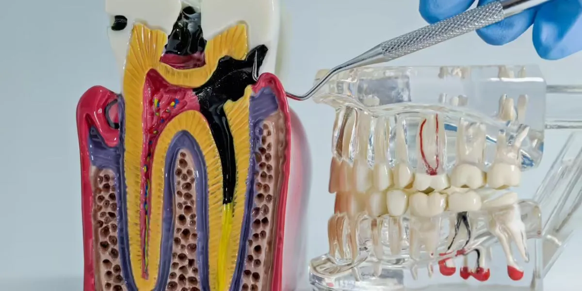 Routine Tooth Extraction Triggers Rare, Vision-Threatening Eye ...